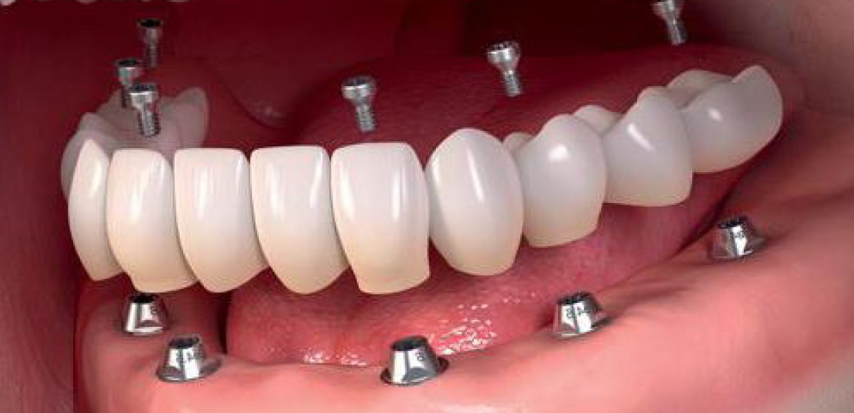 All-On-X Dental Implants: A Comprehensive Guide