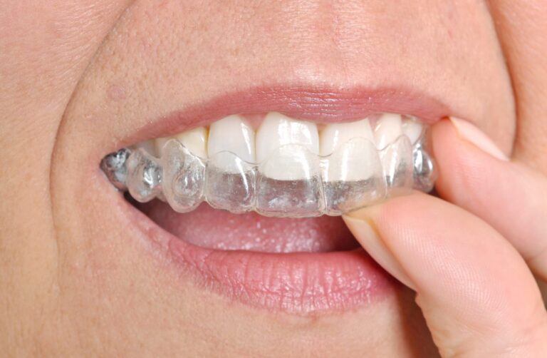 How Long Does Invisalign Pain Last? Realistic Guide