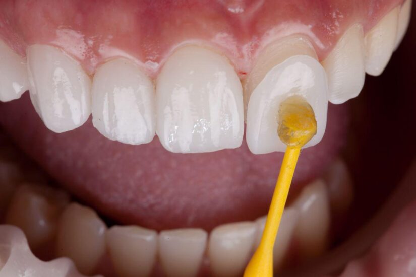 Everything You Need to Know About Front Tooth Crown
