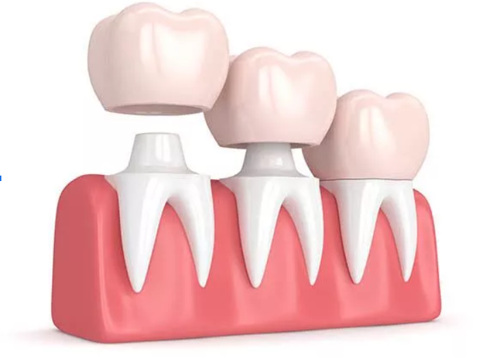 When Do You Need a Dental Crown? | Rockville Dental Arts