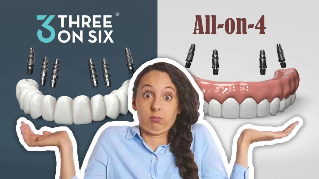 A Comprehensive Guide to 3 on 6 Dental Implants