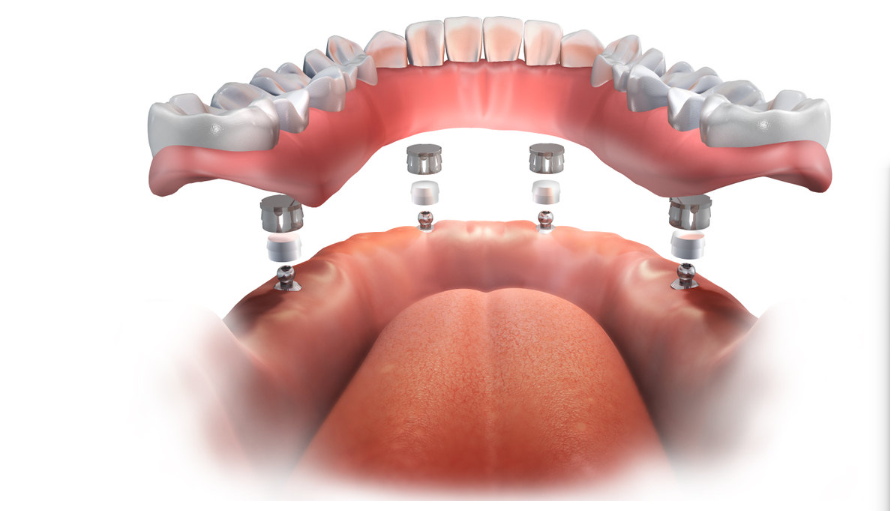 Why Denture Fit Matters: Risks of Poorly Fitting Dentures