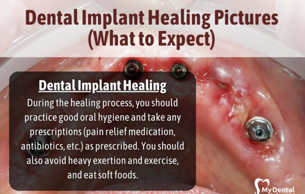 Dental Implant Healing Stages Rockville MD Guide