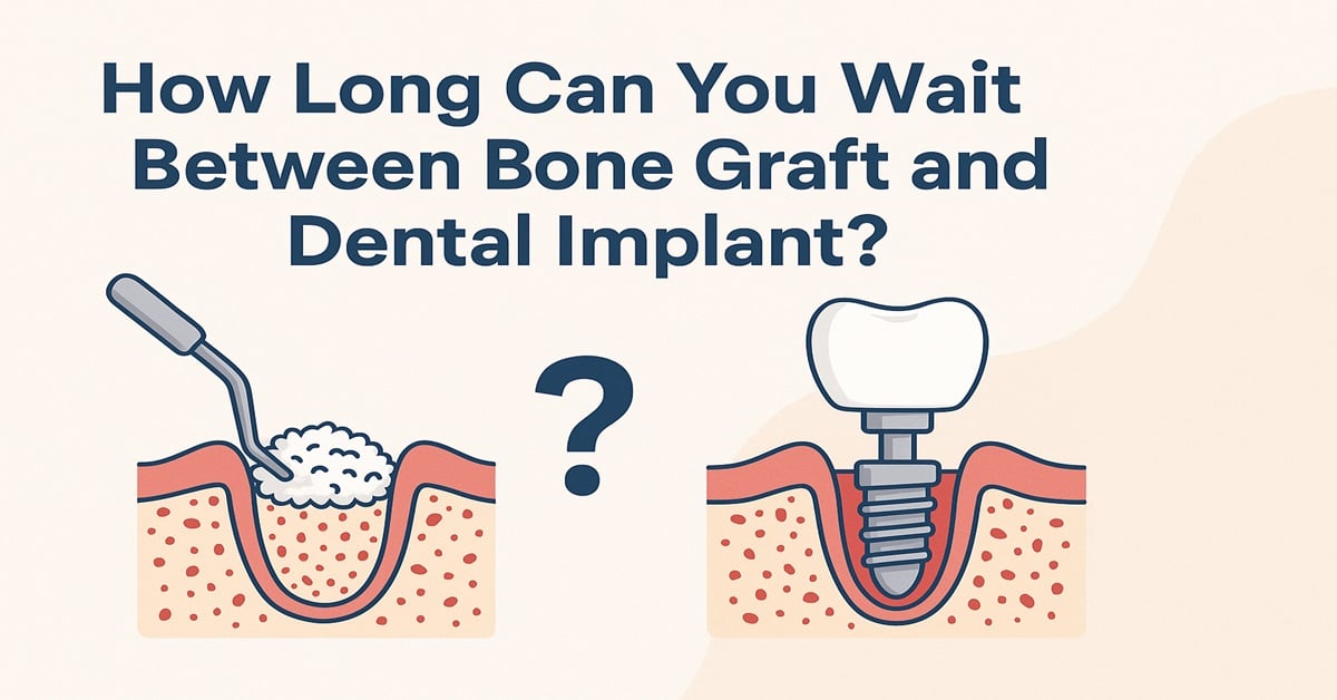 How Long Can You Wait Between Bone Graft & Dental Implant?