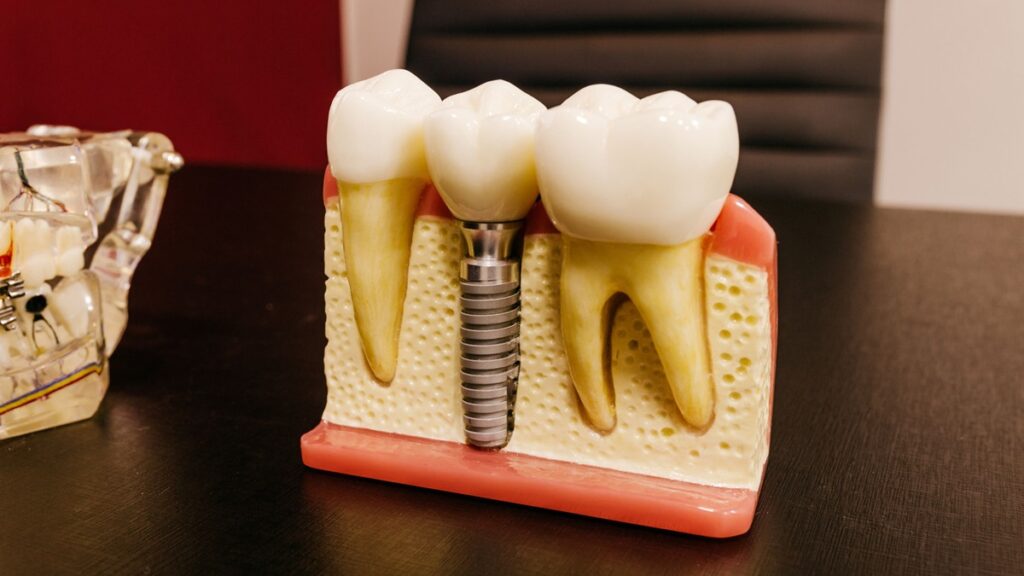 Complete Bone Graft Guide for Dental Implant Patients