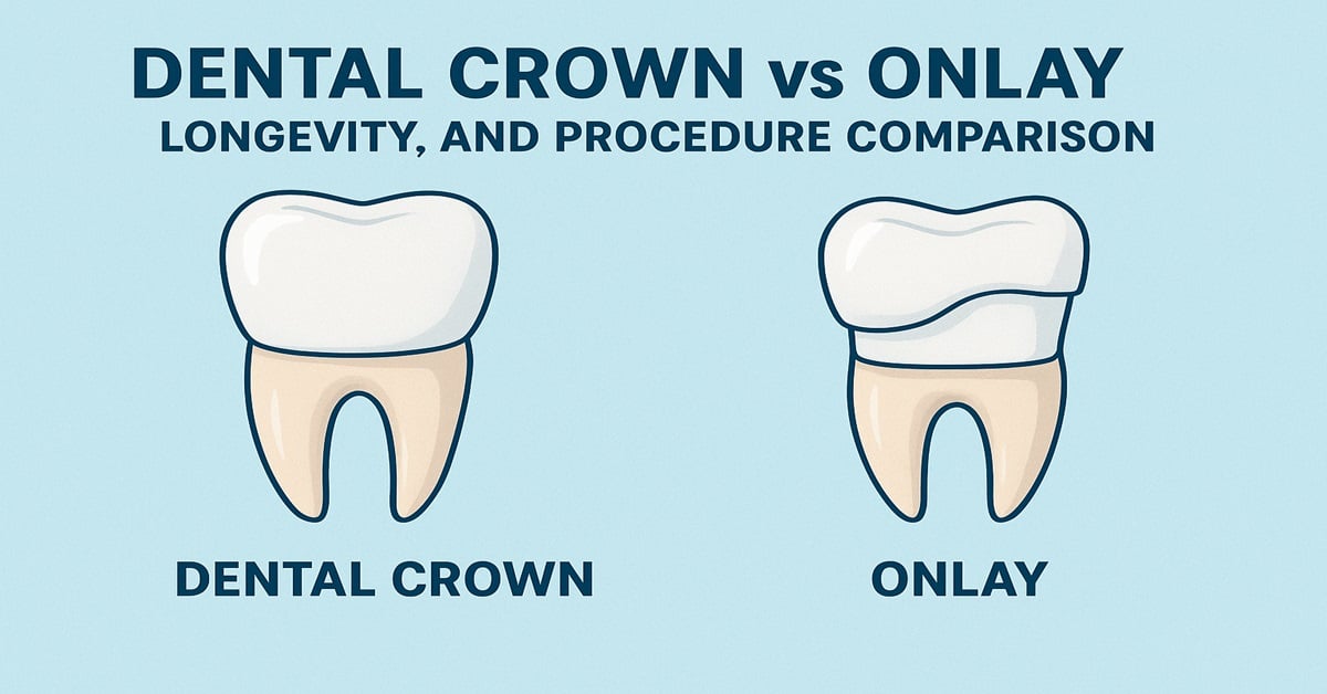 Dental Crown vs Onlay: Longevity & Procedure Comparison