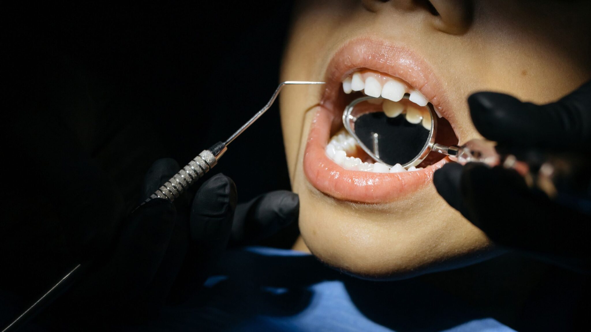 Dental Crown vs Onlay: Longevity & Procedure Comparison